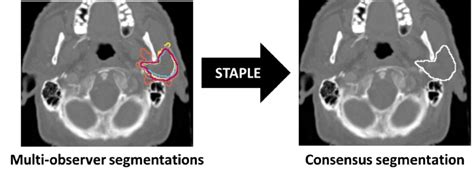 Expert Segmentations Of The Left Parotid Gland In The Head And Neck Download Scientific Diagram