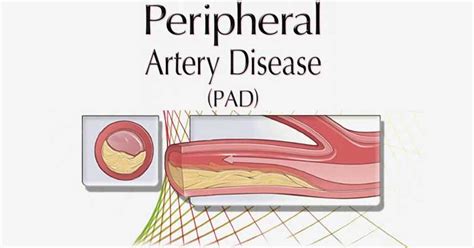 pad diagnosis overview meds wiki