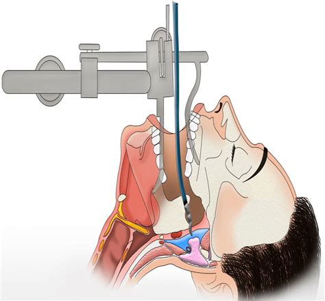 Transoral Robotic Surgical Approach To The Parapharyngeal Space