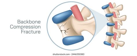 4 Hundred Thoracic Compression Fracture Royalty Free Images Stock Photos Pictures Shutterstock