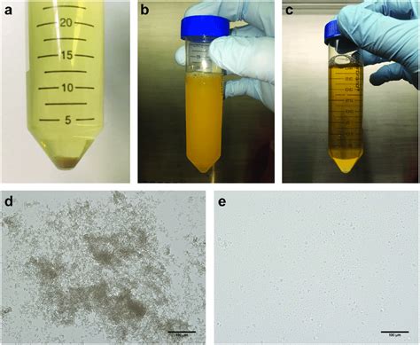 Stain Precipitate In Urine