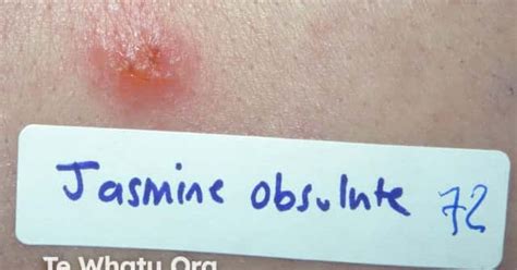 Positive Patch Tests To Jasmine Absolute Oil Image