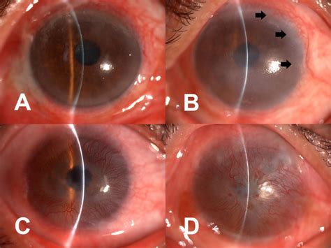 Grading Neovascularization In The Eyes A Grade 0 No Invasion Of The Download Scientific