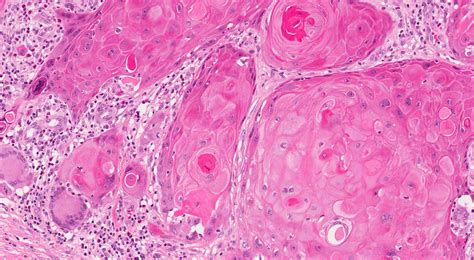 Squamous Cell Carcinoma Histology