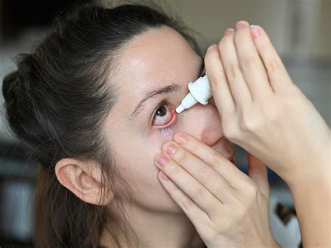 Conjunctivitis