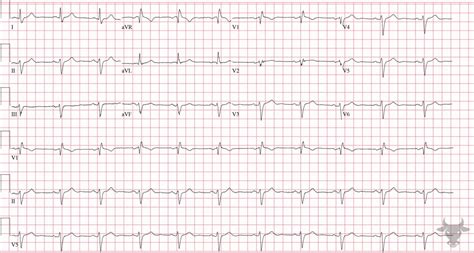 Bifascicular Block Ecg Stampede