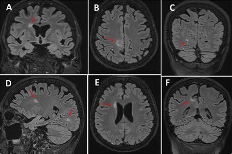 New Late Onset Relapsing Remitting Multiple Sclerosis In A Woman In