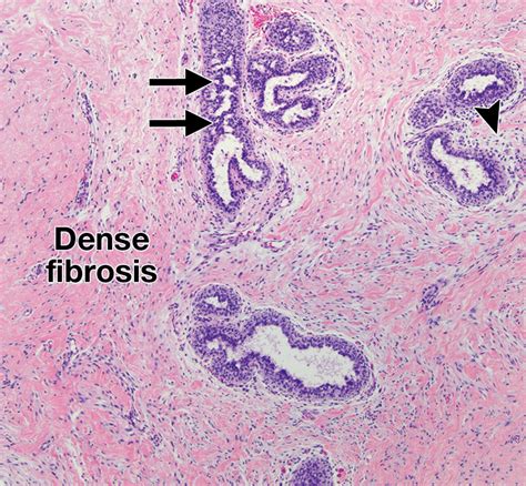 Gynecomastia Sonographic Tendencies
