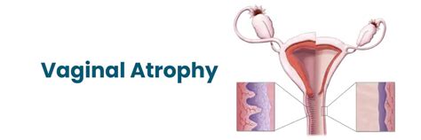 Vaginal Atrophy Causes And Treatments Medicover Hospitals