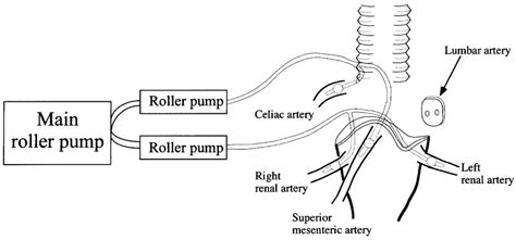 Schema Of Selective Perfusion Of Visceral Organs With Perfusion Of The
