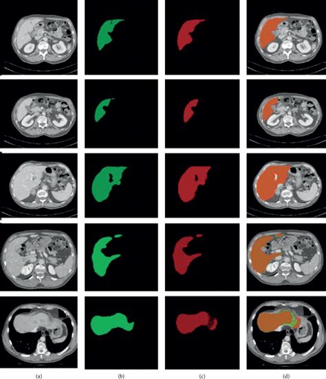 Figure 8 From A Lightweight Convolutional Neural Network Model For Liver Segmentation In Medical