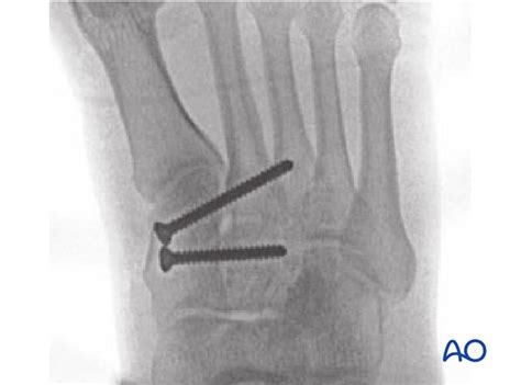 Treatment Of Lisfranc Injuries For Lisfranc Injuries