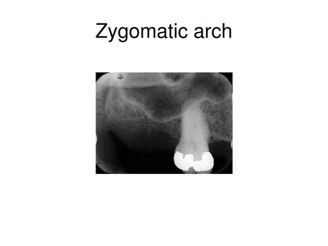 Zygomatic Arch Inferior View Perysouth