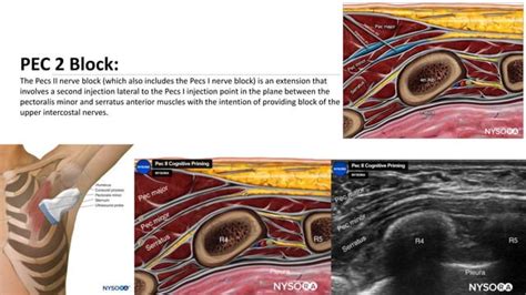 Usg Guided Nerve Blocks Pec 1 Pec 2 Block Pptx Death Injury Or