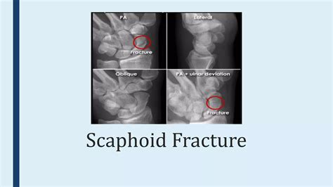 Upper Limb Fractures Pptx
