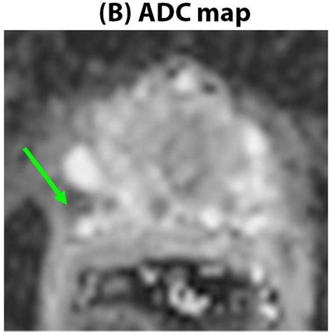 84 Year Old Man With Prostatic Calcification Mimicking Prostate Cancer Download Scientific