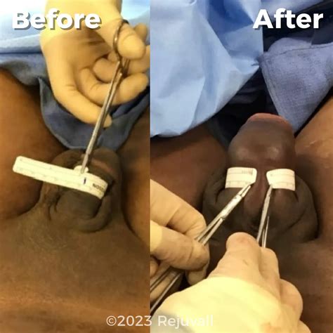 Male Enhancement Surgery Results