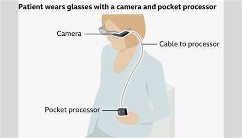 Blindness Cured With Revolutionary ‘eye Implants By Medical Experts