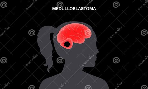 Medulloblastoma Brain Cancer Stock Illustration Illustration Of