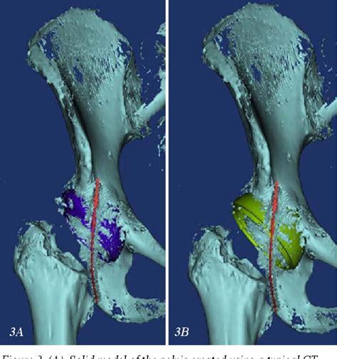 Figure 3 From Effects Of Acetabular Cup Orientation And Implant Design On Psoas Impingement In