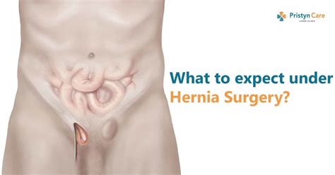 When Can I Have Sex After Hernia Surgery