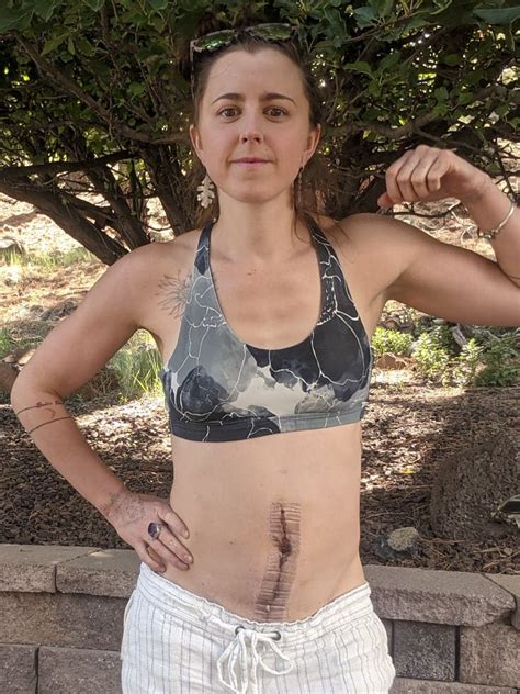 Ariels Stage 4 High Grade Appendix Cancer Story The Patient Story