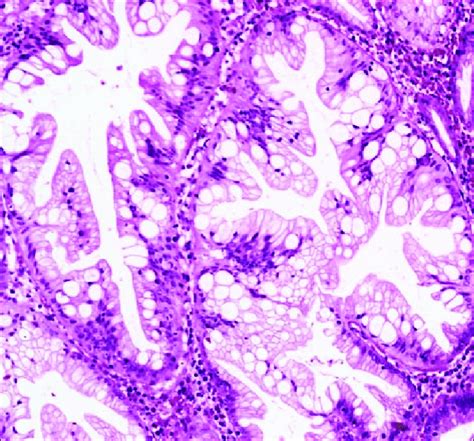 Well Apparent Crypt Serration In The Superficial Part Of SSA The Download Scientific Diagram