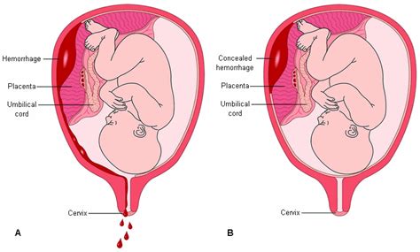 Placental Abruption Symptoms Diagnosis And Treatment Bmj Best Practice Us