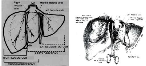 Figure 1 From Experiences Of 30 Years In Right Trisectionectomy For