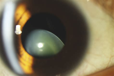 Dislocated Lens Ento Key