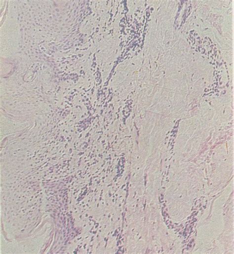 二、毛细血管扩张性环状紫癜 皮肤病临床与病理图谱