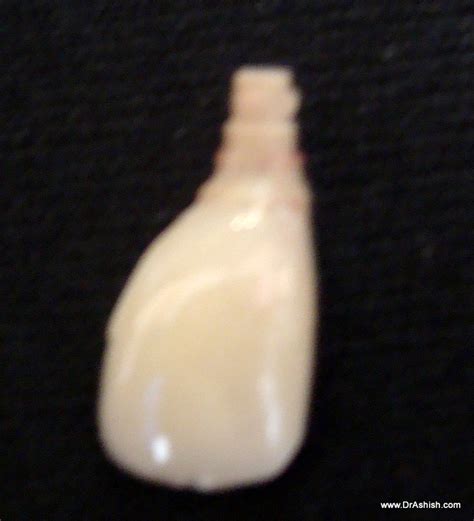 Socket Shield Technique Dr Ashish Shah