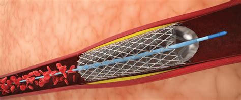 Ffrifr Test Assess Heart Blood Flow