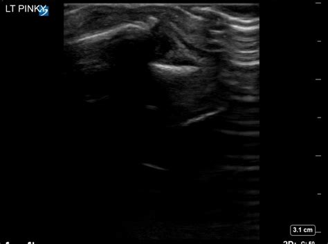 Finger Us Pinky Pipj Dislocation With Small Avulsion Fracture Wiki