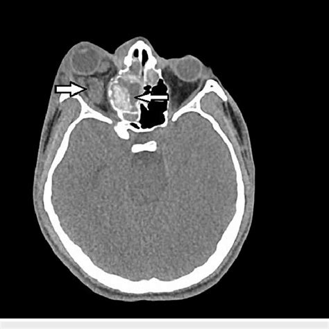 Initial Ct Orbit Showing Sinusitis With Orbital Cellulitis And Small