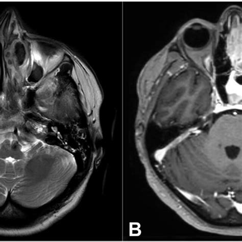 Mri Imaging Showed A Heterogeneous Mass On T2w1 B Hemosinus Was Download Scientific Diagram