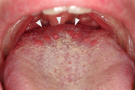 Lingual Tonsil Model