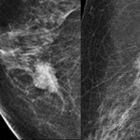 Clustered Coarse Heterogeneous Microcalcifications Associated With A Download Scientific