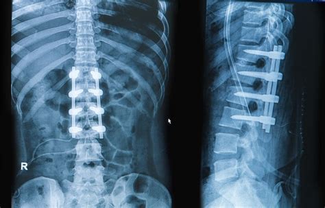 Lumbar Adjacent Segment Disease Joint Rehab And Sports Medical Center