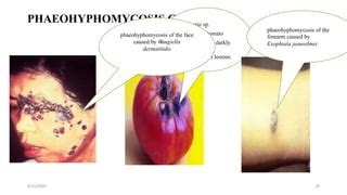 Chromoblastomycosis And Phaeohyphomycosis Pptx