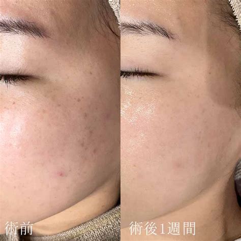 ピコトーニングの症例写真・費用・リスク・副作用 美容皮膚科なら水の森美容クリニック