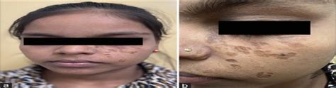Indian Journal Of Paediatric Dermatology