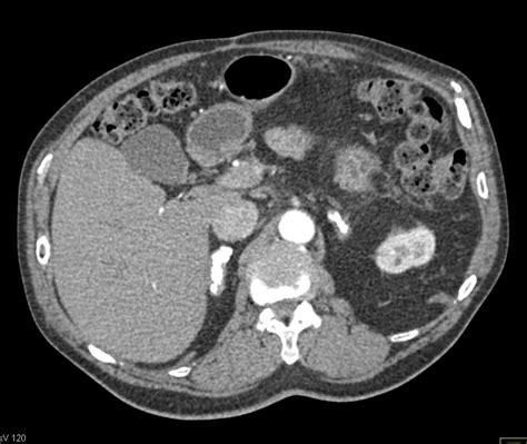 Calcified Adrenal Glands Due To Prior Tuberculosis Tb Adrenal