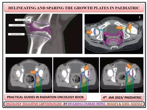 Pentec Guidelines For Paediatric Radiotherapy Pptx