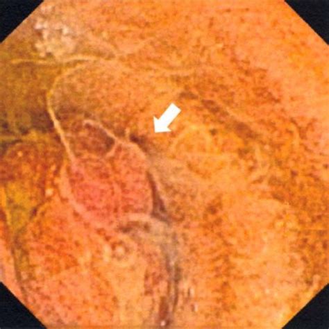Pdf A Case Of Lobulated And Pedunculated Duodenal Hyperplastic Polyp