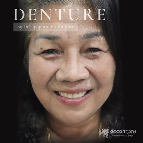 ขอขอบคุณภาพจาก “คุณกุลยา” ในการรีวิว ฟันปลอม แบบถอดได้ ทั้งปาก โดยทันตแพทย์หญิงทิพาพร หมอ