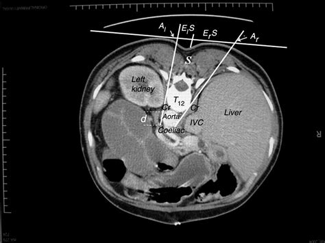 Celiac Plexus Anatomy