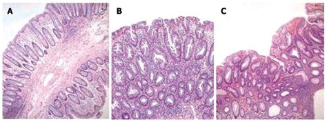 Filiform Polyposis In The Sigmoid Colon A Case Series