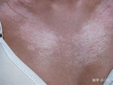 硬皮病患者的疑问？ 知乎