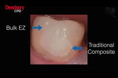 Dentistry Cpd Polymerisation Shrinkage With Bulk Fill Composites
